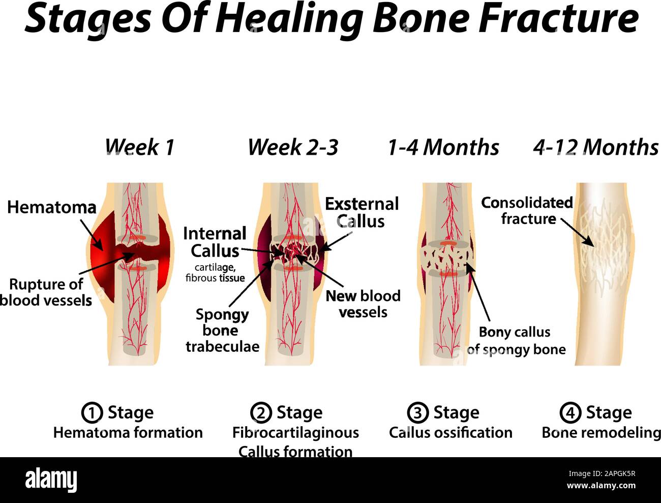 Bone Remodeling After Fracture