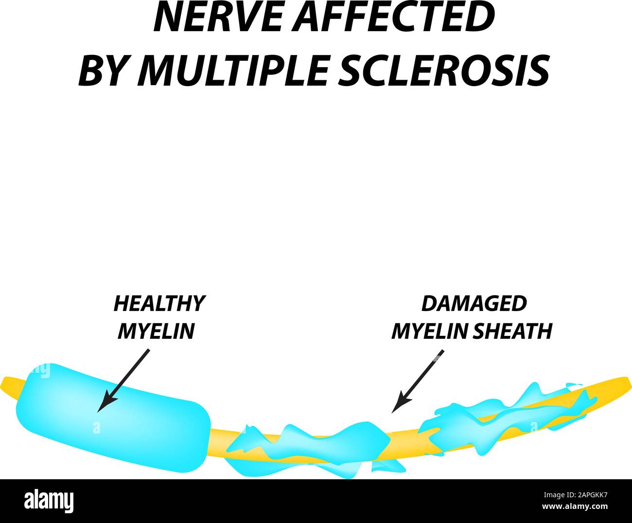 The destruction of the myelin sheath on the axon. Damaged myelin. Neuron affected by multiple ...