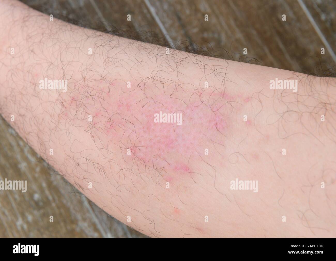 Closeup human legs with scar texture Stock Photo - Alamy
