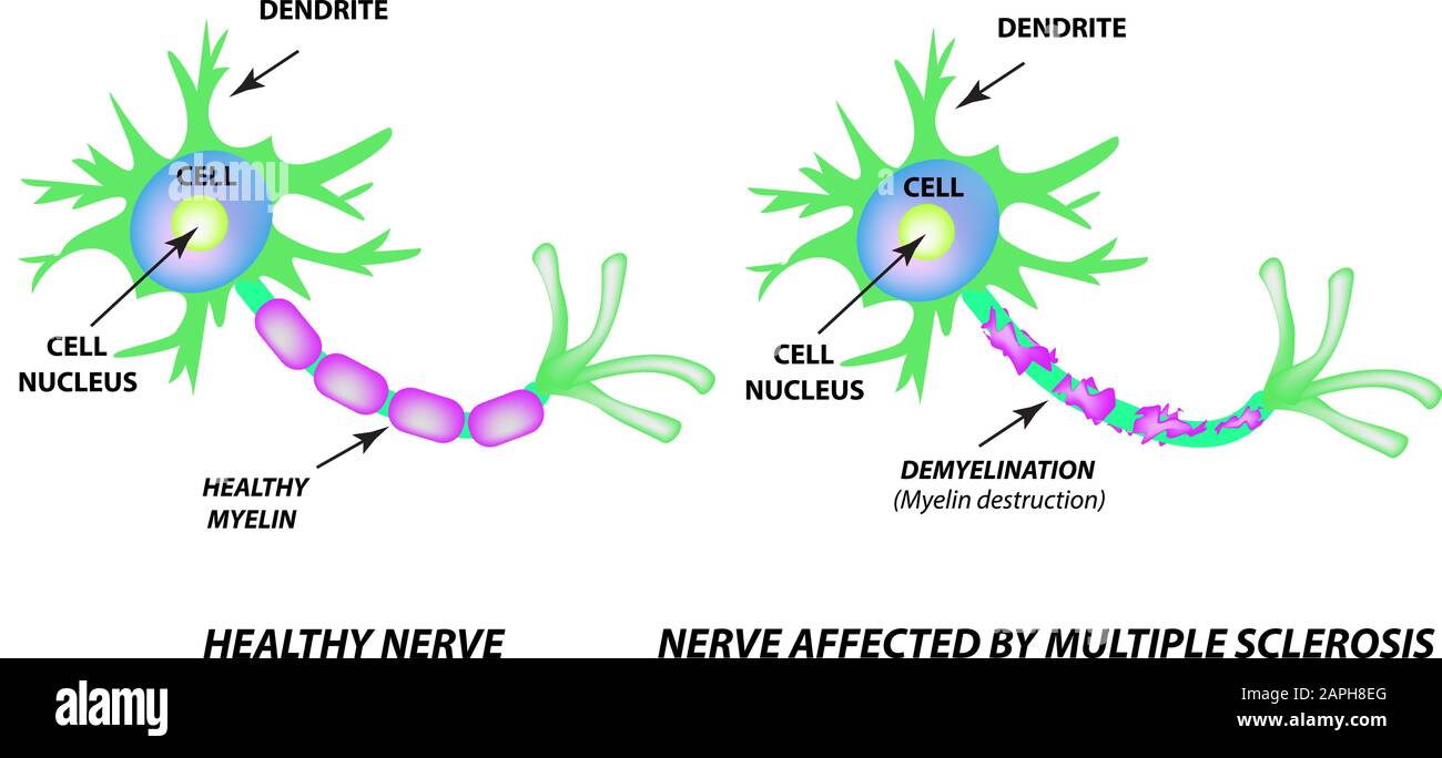 The destruction of the myelin sheath on the axon. Damaged myelin ...