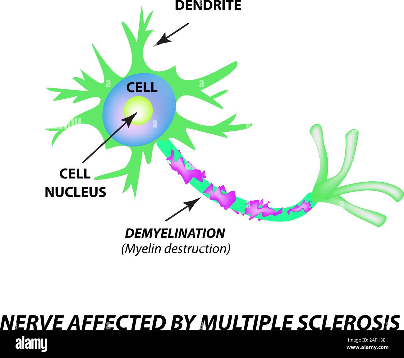 The destruction of the myelin sheath on the axon. Damaged myelin ...