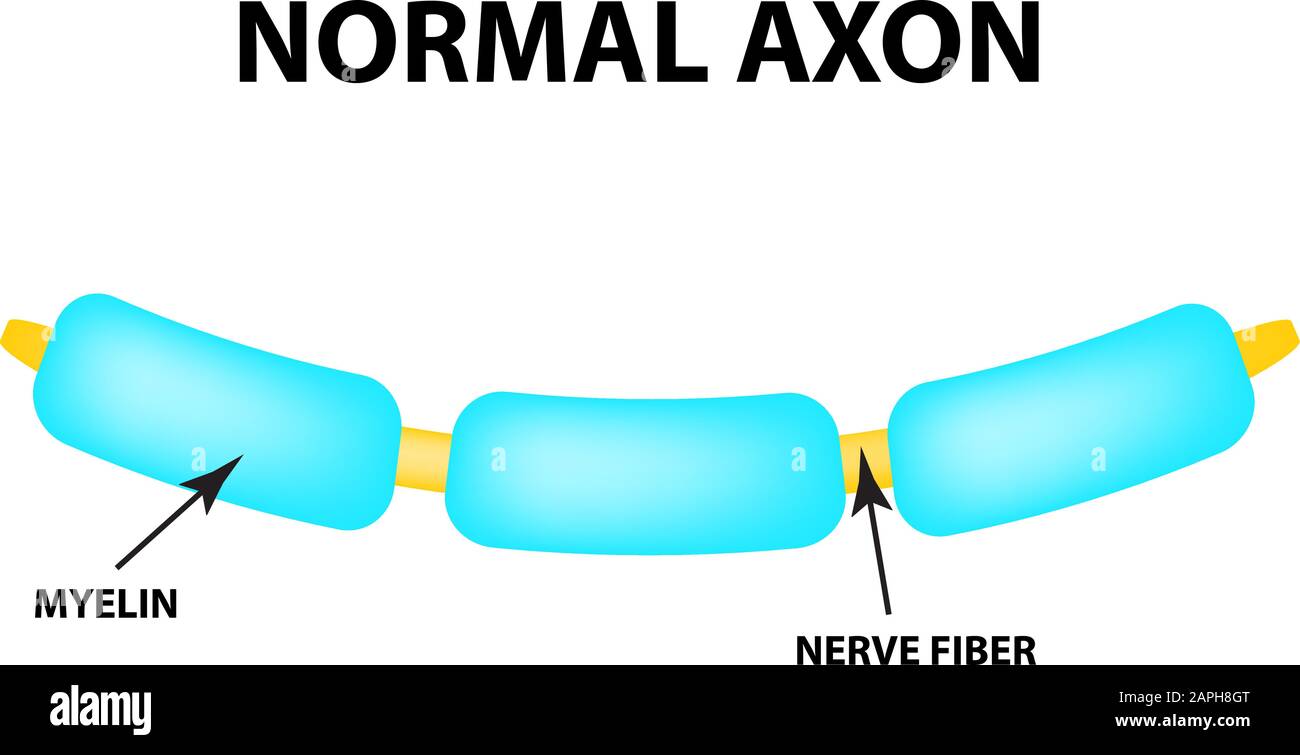 Normal axon. Healthy myelin. World Multiple Sclerosis Day. Infographics ...