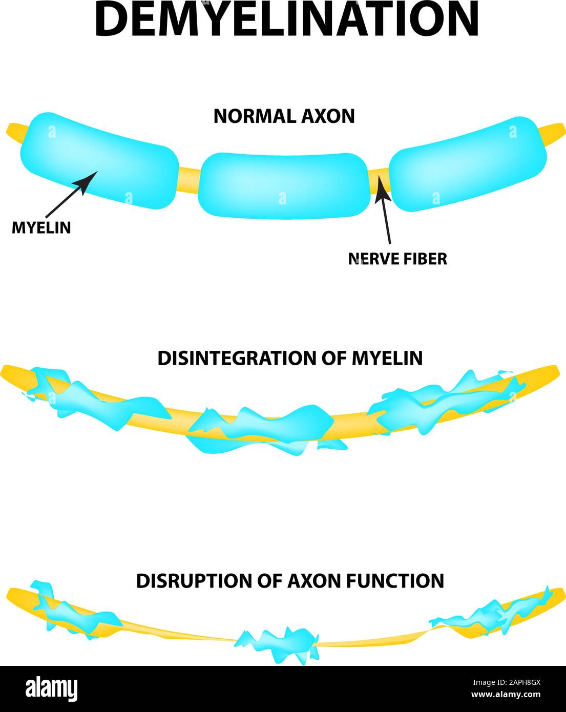 The destruction of the myelin sheath on the axon. Damaged myelin ...