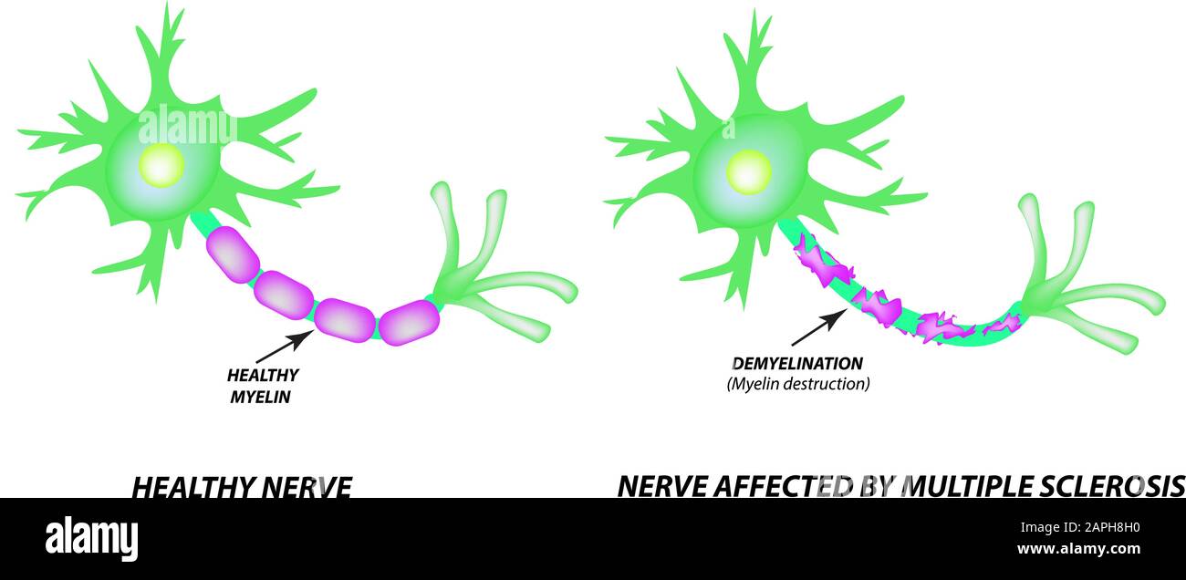 The destruction of the myelin sheath on the axon. Damaged myelin ...