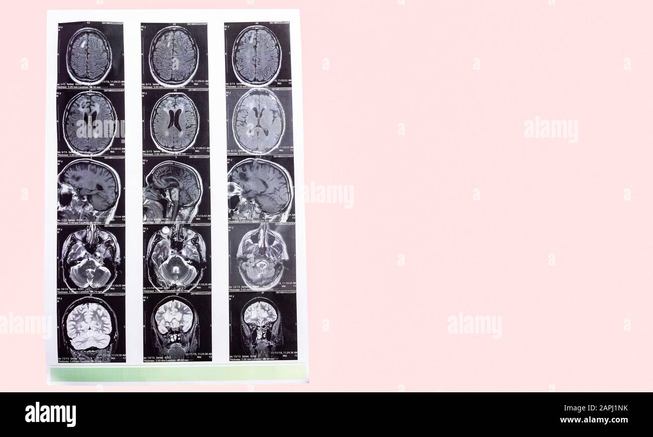 The magnetic resonance image or MRI of the male brain Stock Photo - Alamy
