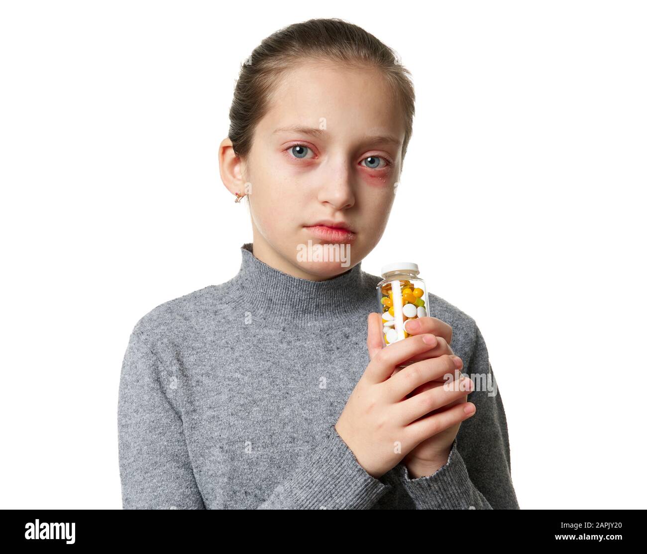 Allergic reaction, skin rash, close view portrait of a girl's face ...