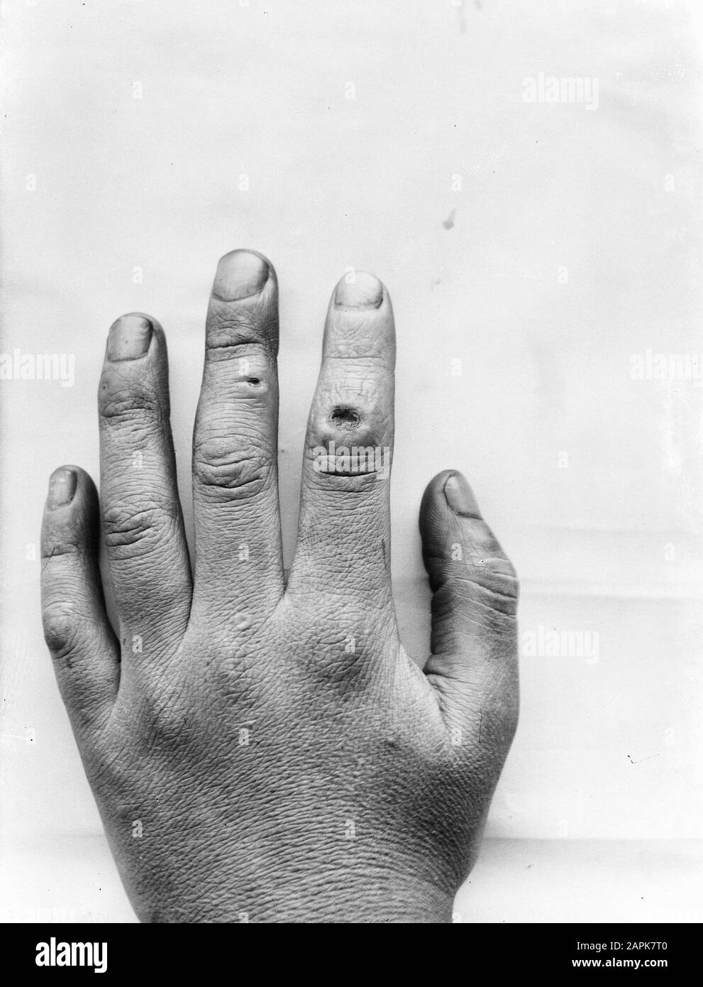 9x12 Occupational diseases (chromatous ulcers) Date: December 1911 ...