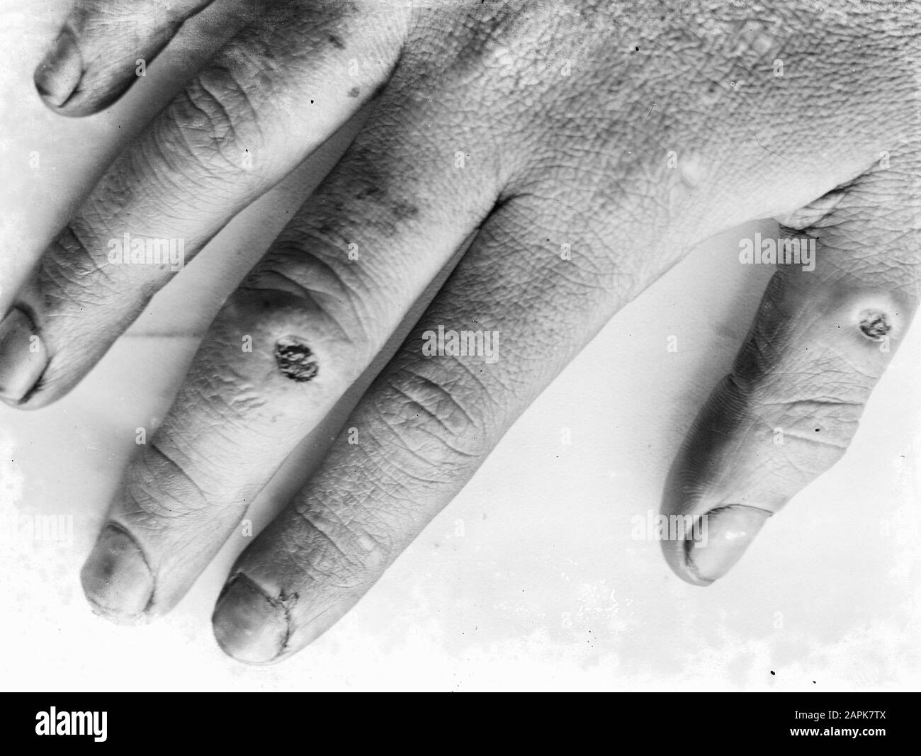 9x12 Occupational diseases (chromatous sores at the 14-year-old De Beer ...