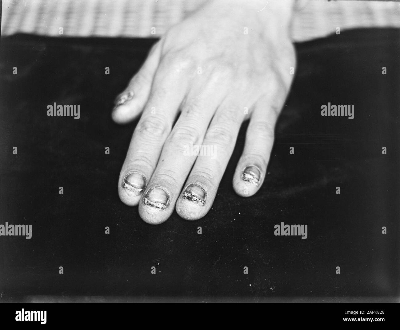 9x12 Occupational diseases (nail crumbling by chlorine lime)/nail ...