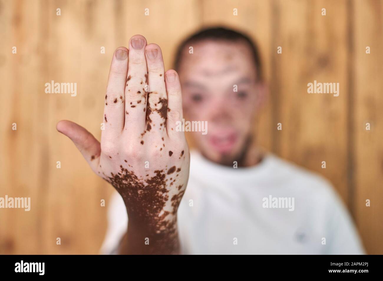 Vitiligo male hi-res stock photography and images - Alamy