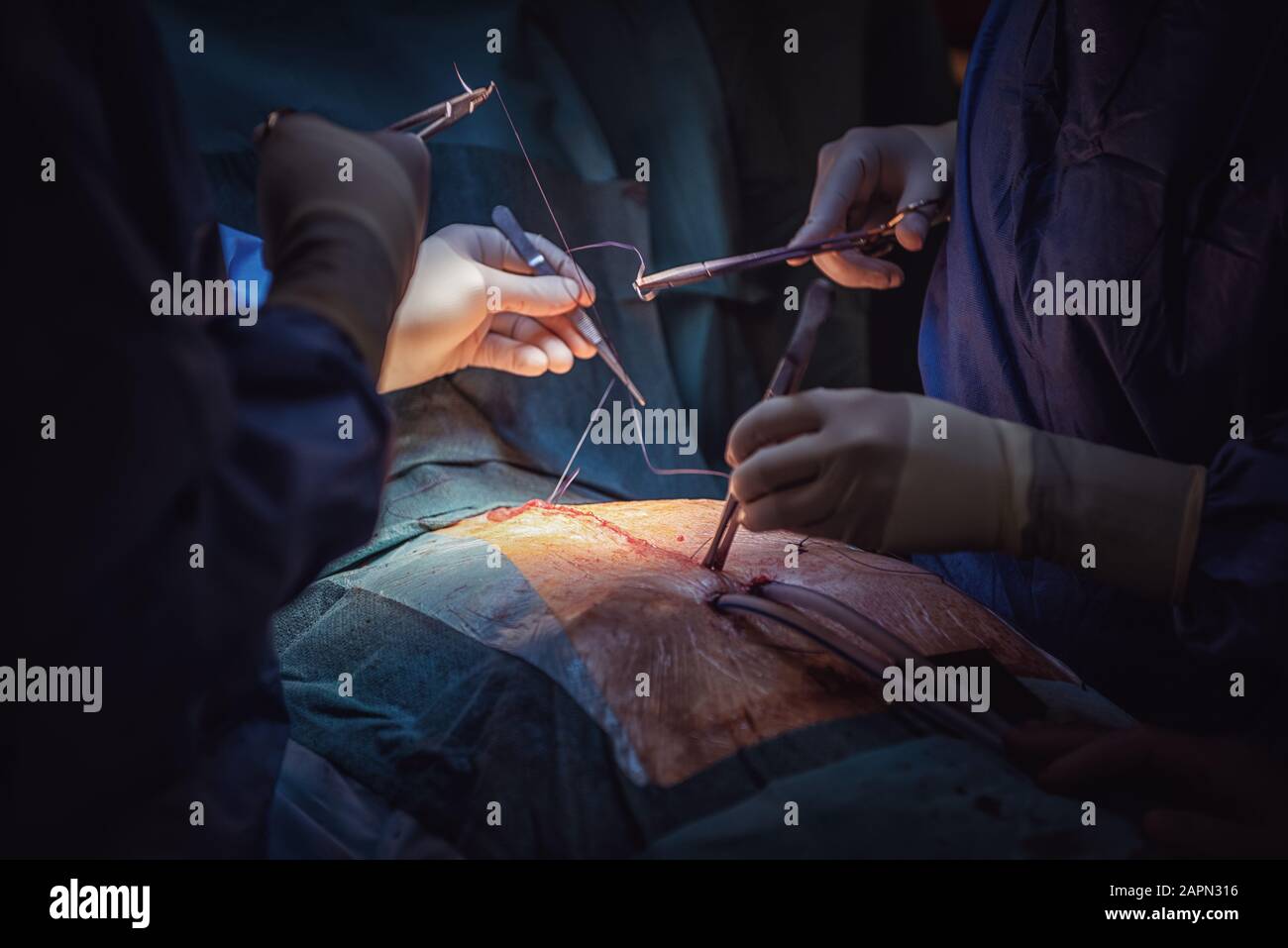 Thoracotomy hi-res stock photography and images - Alamy