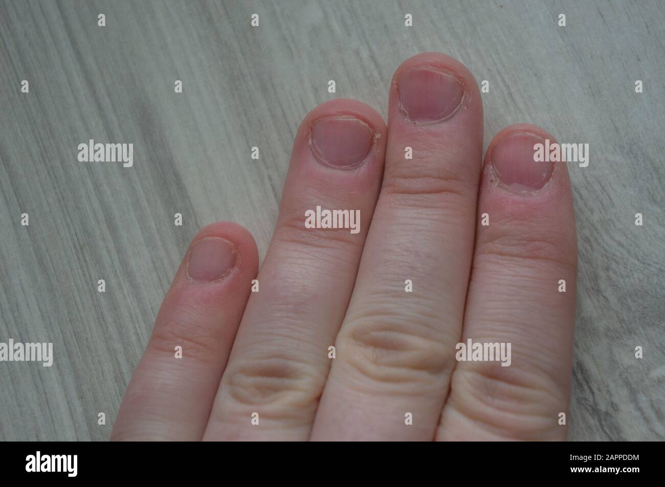 Excoriation hi-res stock photography and images - Alamy