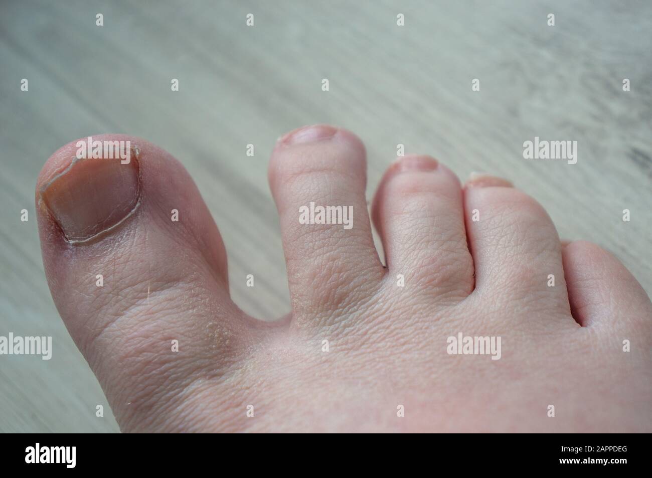 Close up of toes with focus on big toenail with damage to nail and skin ...