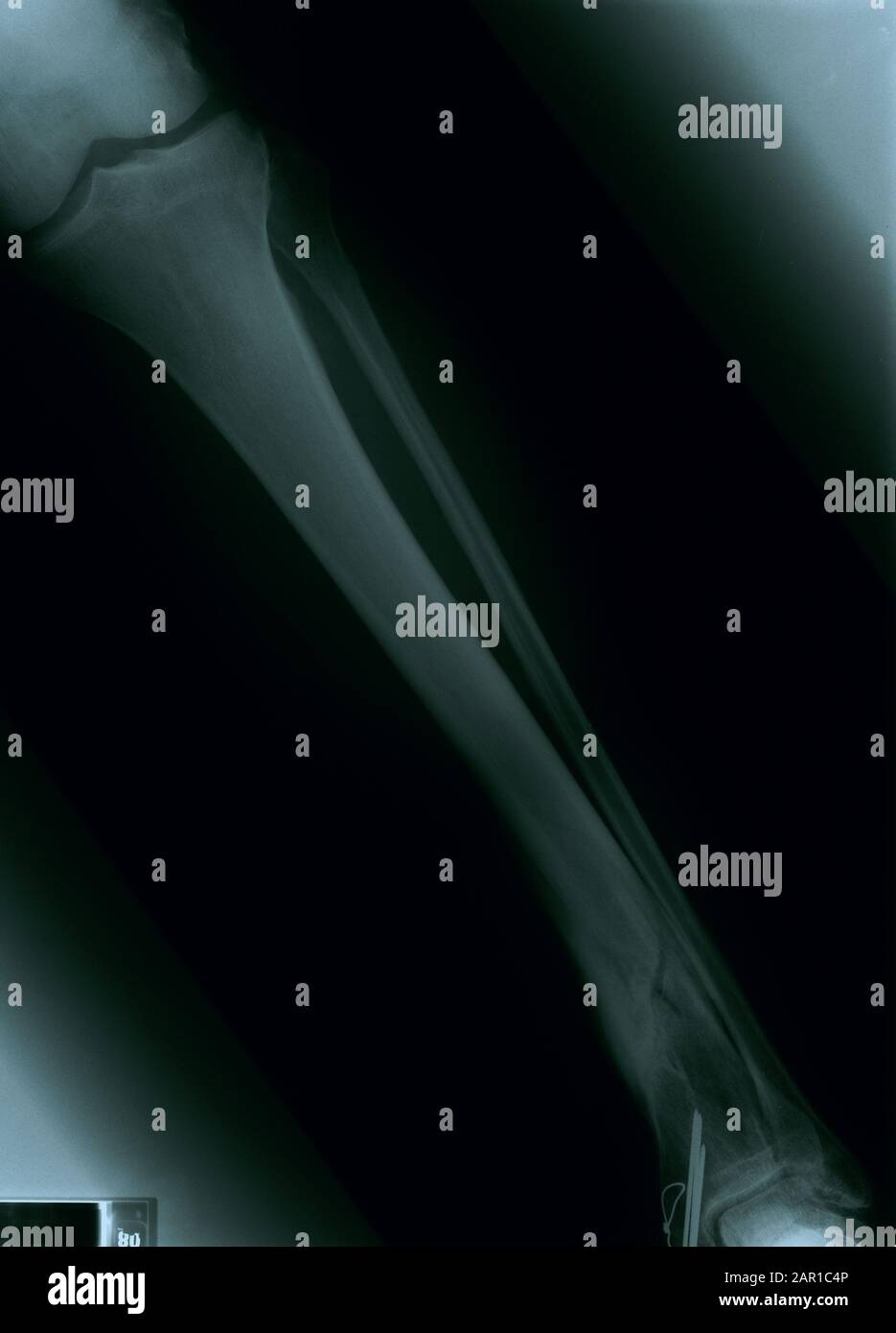 RADIOGRAFIA DE TIBIA CON ROTURA Y TORNILLOS EN EL TOBILLO Stock Photo ...