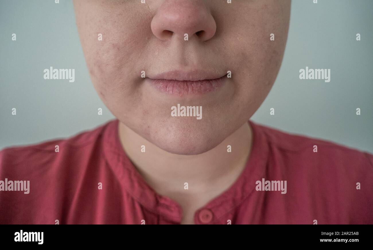 Excoriation hi-res stock photography and images - Alamy