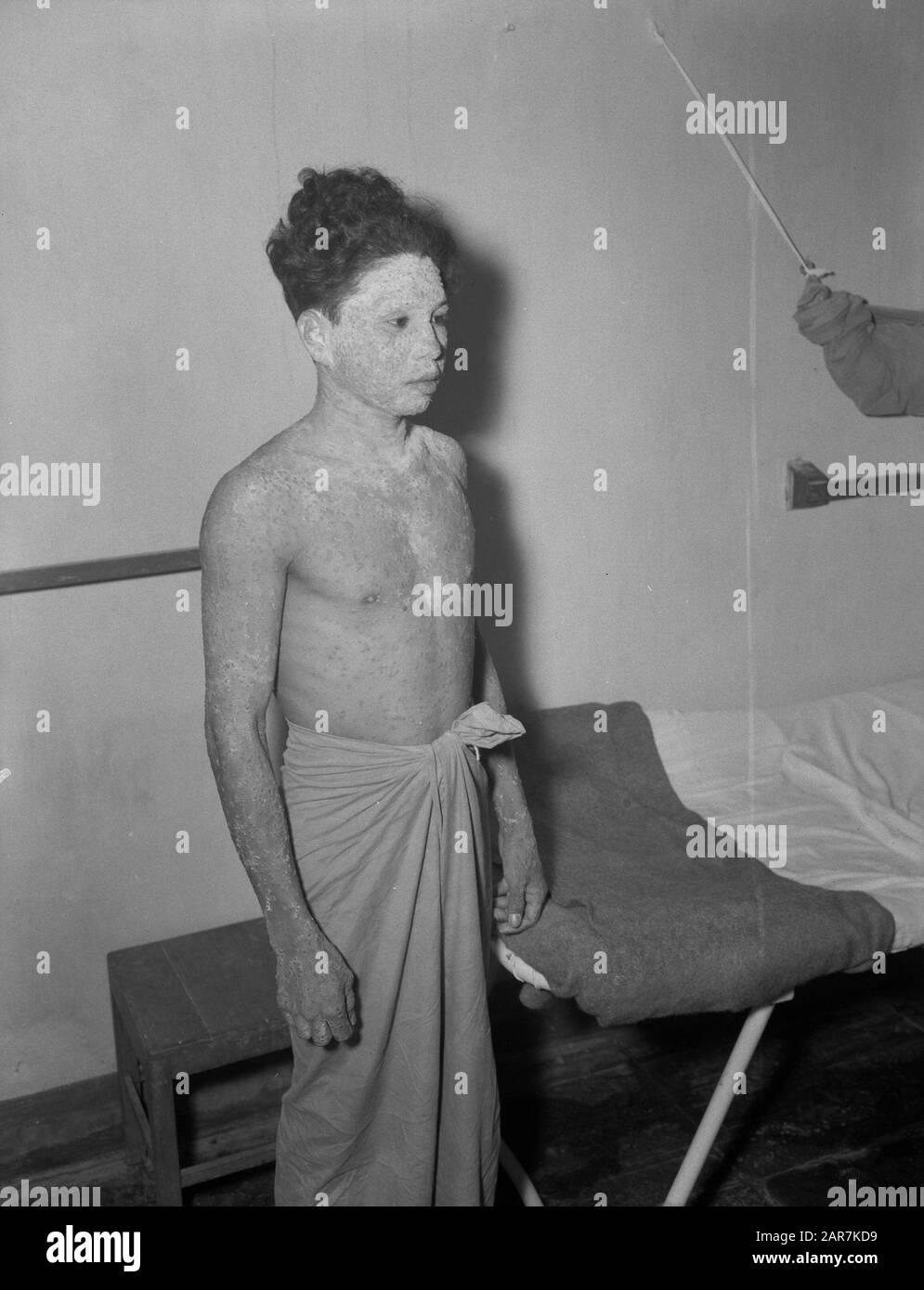 Smallpox patient hi-res stock photography and images - Alamy