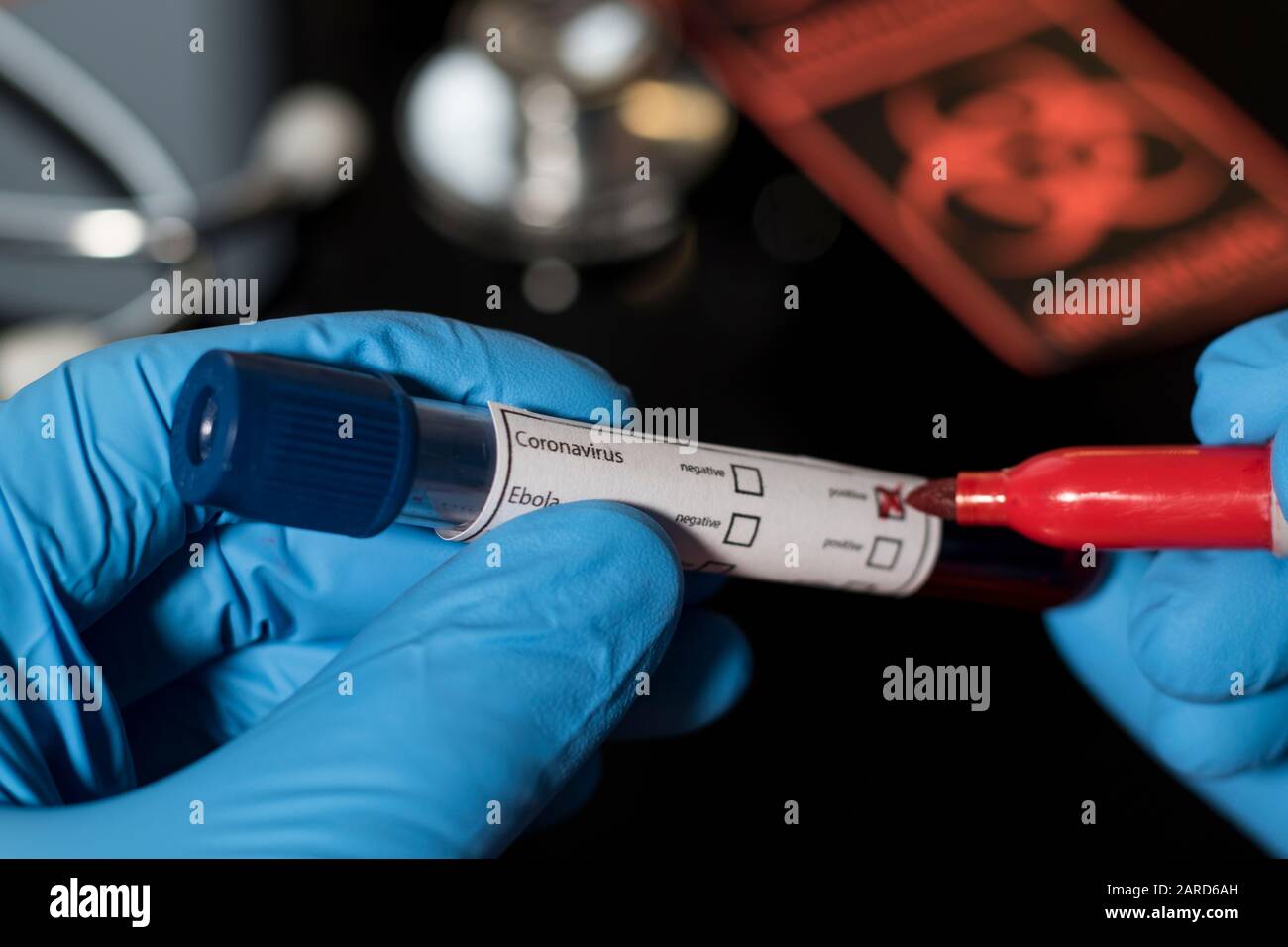 Wuhan coronavirus positive blood test. Corona respiratory syndrome ...