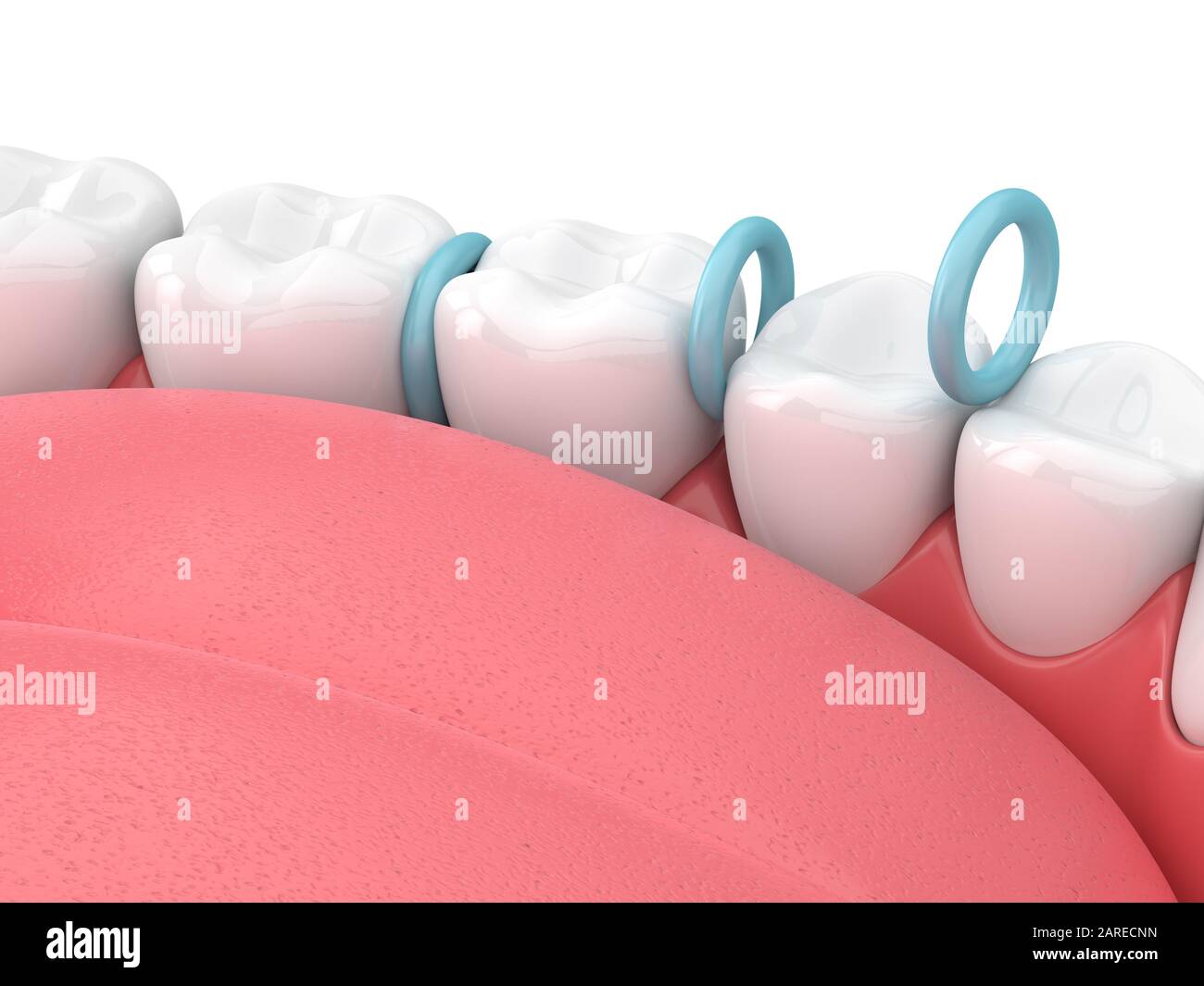 3d render of rubber separators between teeth. Preparation for braces ...