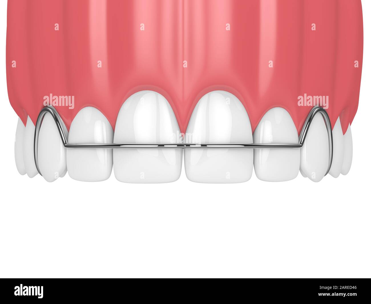 3d render of jaw with orthodontic removable retainer over whte ...