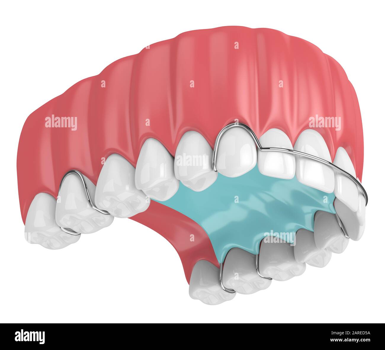 Orthodontic retainer Cut Out Stock Images & Pictures - Alamy