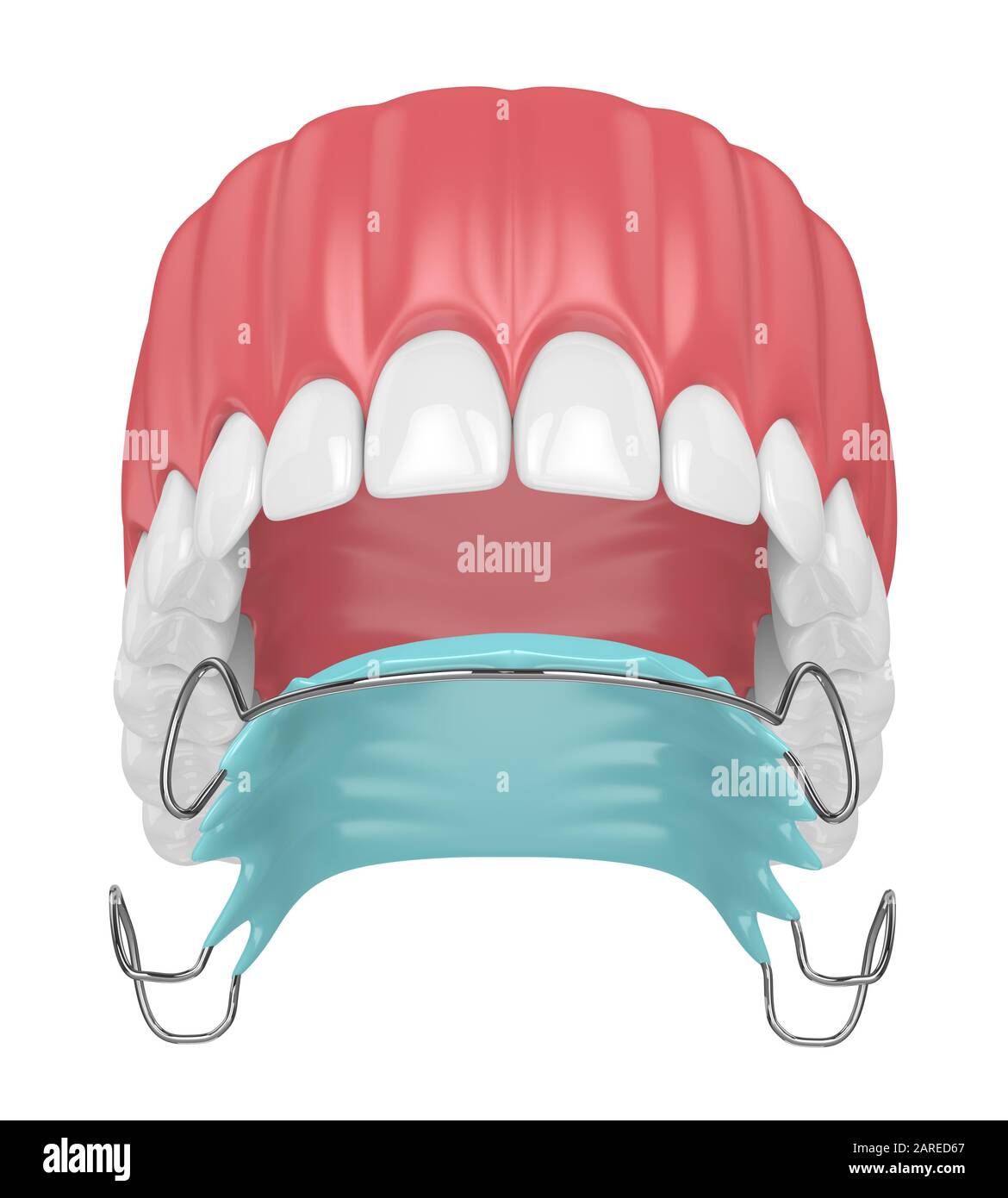 3d render of jaw with orthodontic removable retainer over whte ...