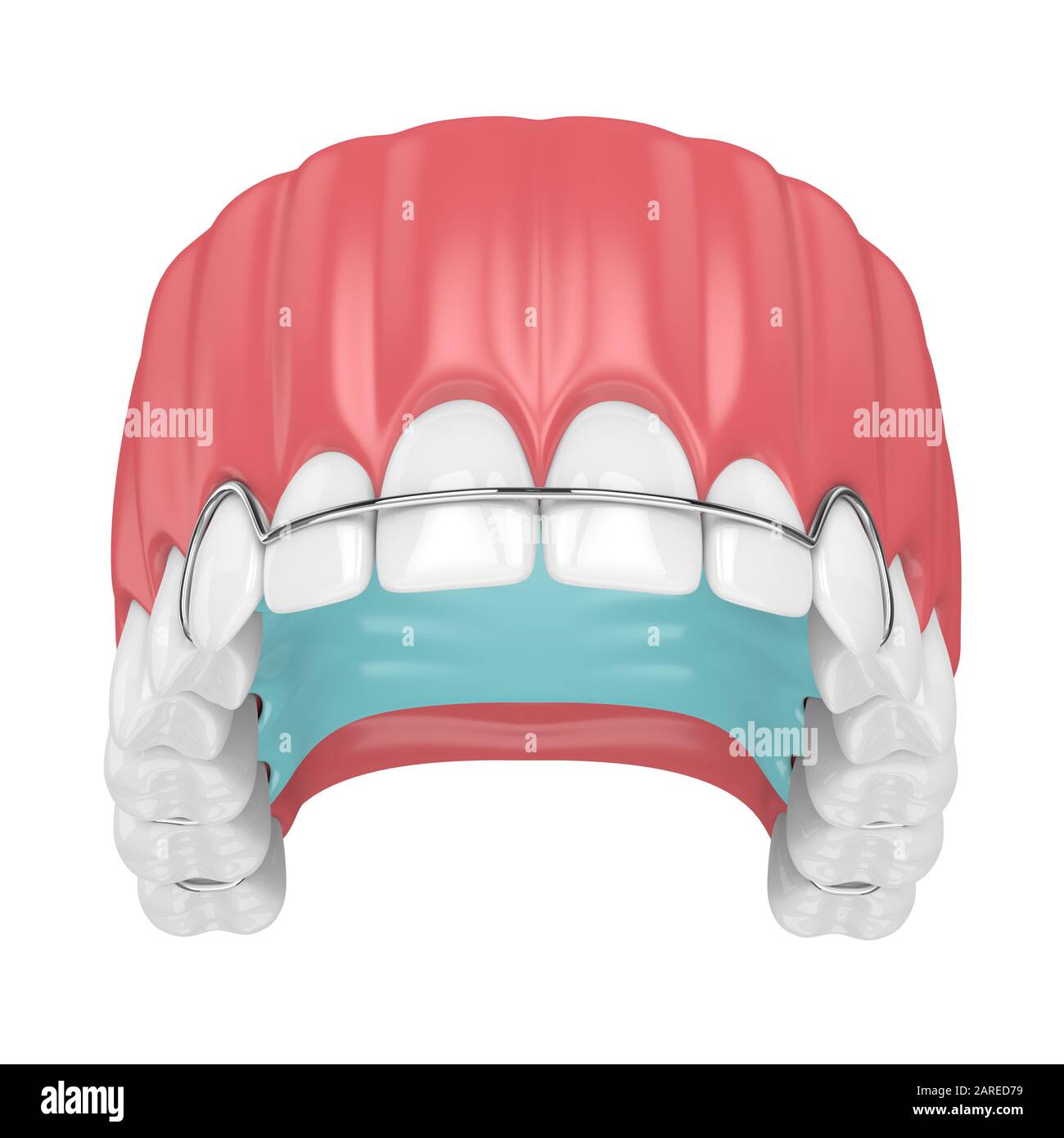 3d render of jaw with orthodontic removable retainer over whte ...