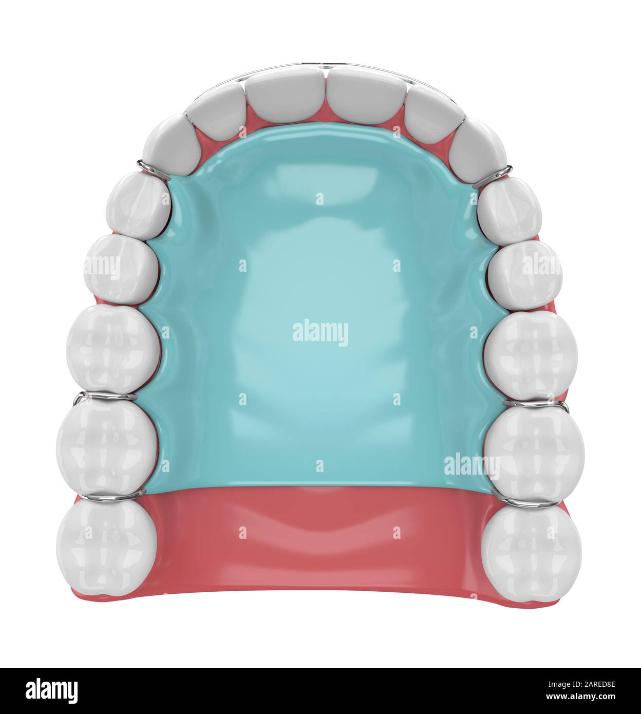 3d render of jaw with orthodontic removable retainer over whte ...