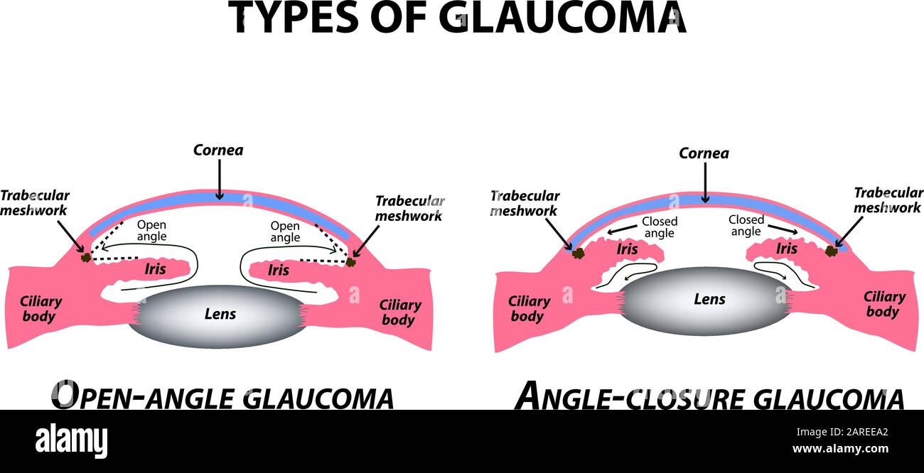 Types of glaucoma. Open-angle and angle-closure glaucoma. The ...