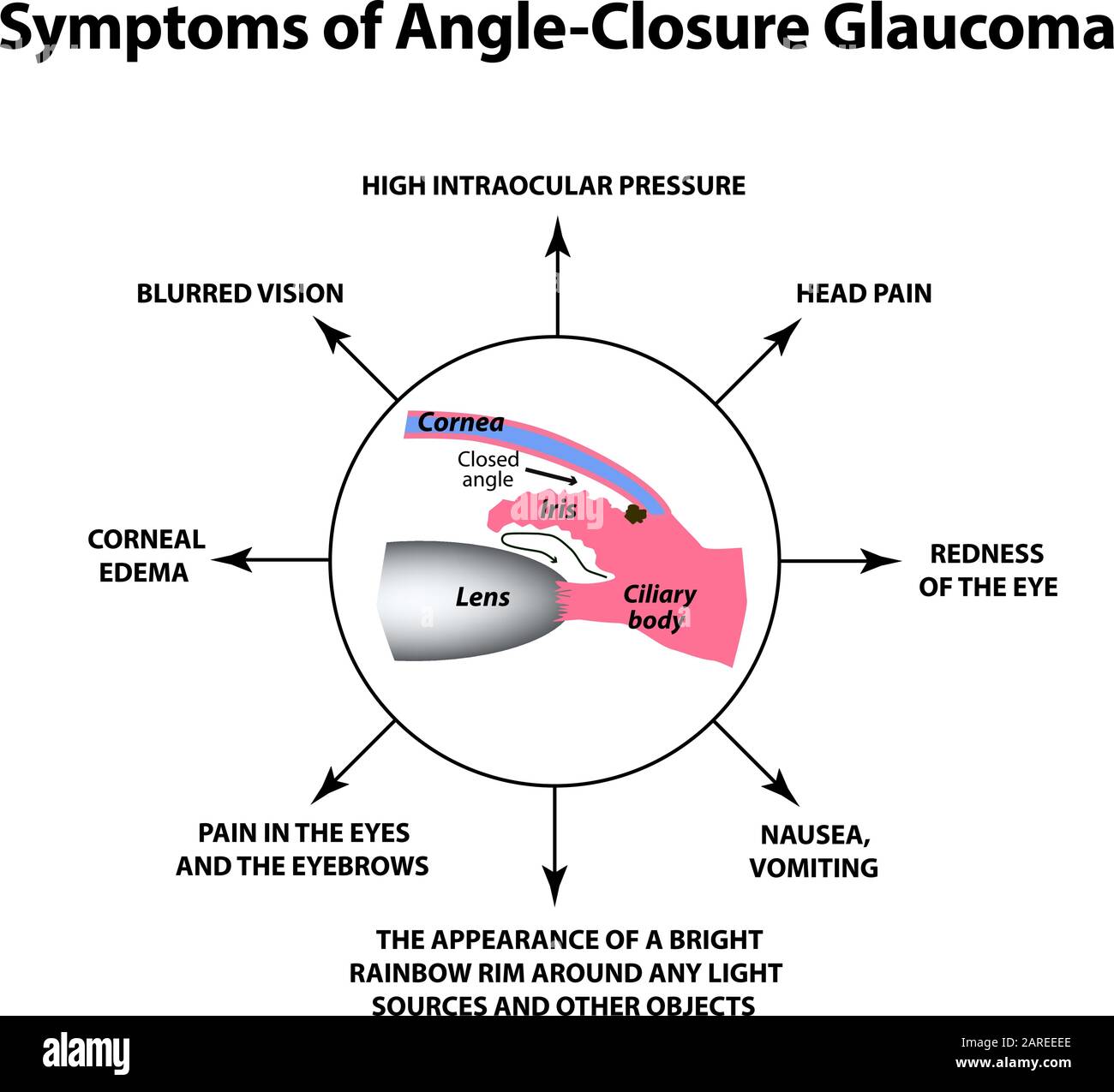 The symptoms of closed angle glaucoma. World glaucoma day. The ...