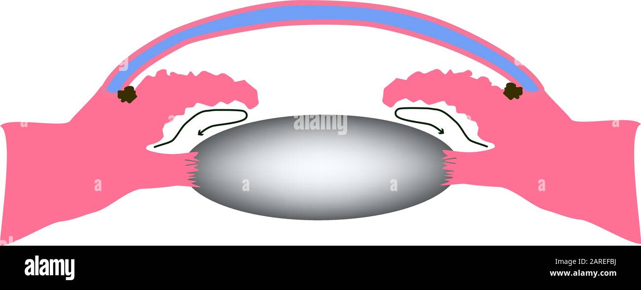 Closed angle glaucoma. A common type of glaucoma. The anatomical ...