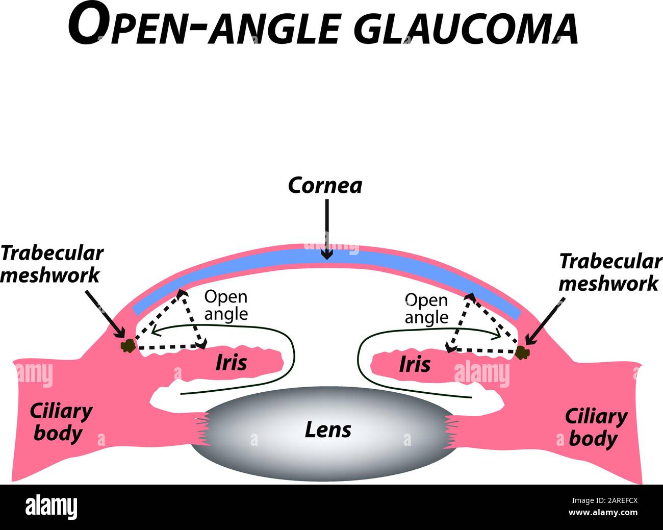Open-angle glaucoma. A common type of glaucoma. The anatomical ... Open-angle glaucoma. A common type of glaucoma. The anatomical ...