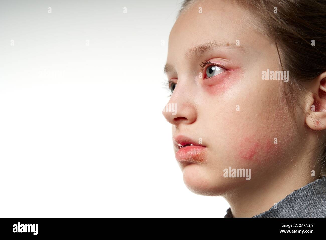 Allergic reaction, skin rash, close view portrait of a girl's face ...