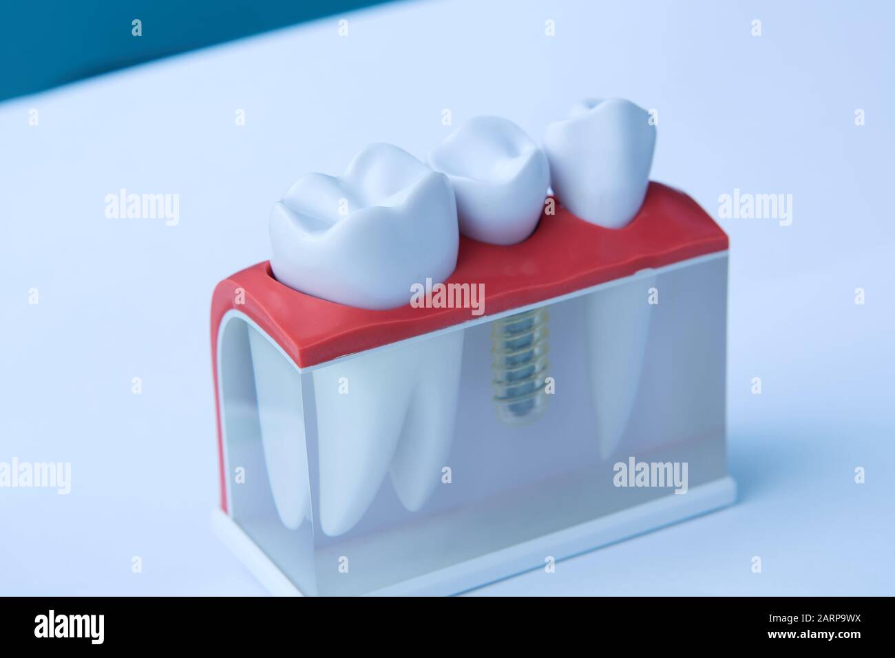 Dentists tooth plastic model with screw implant for teaching, learning ...