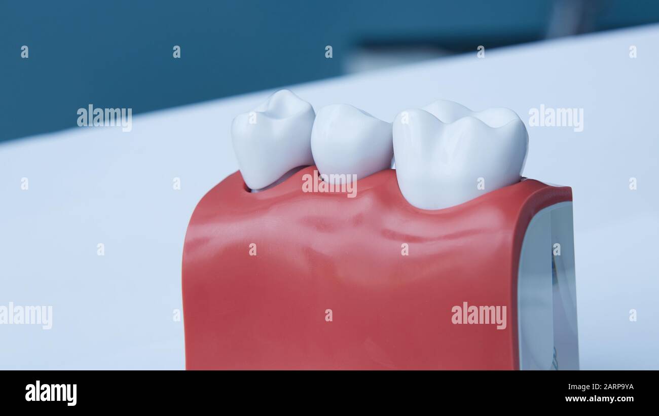 Dentists tooth plastic model with screw implant for teaching, learning ...