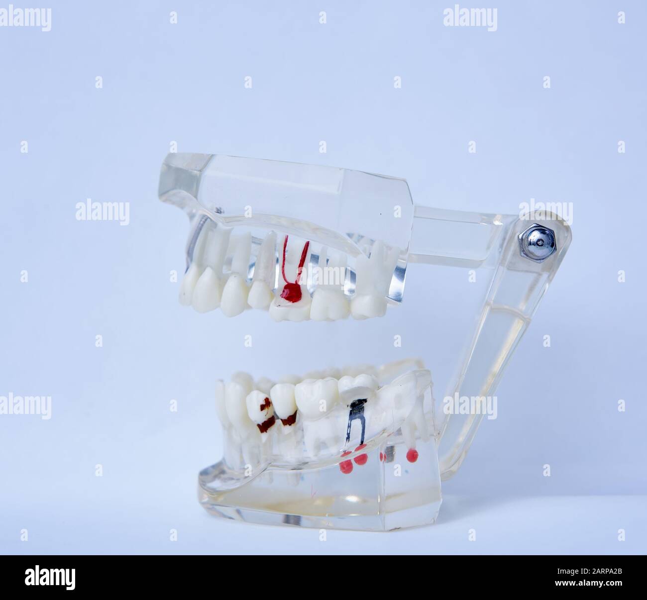 Close up of a Dental implant model Stock Photo - Alamy