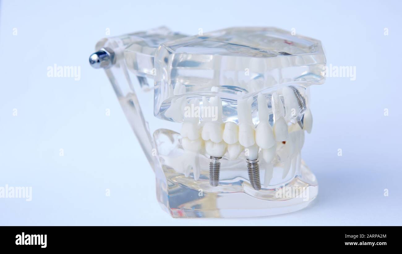 Dentists tooth plastic model with screw implant for teaching, learning ...