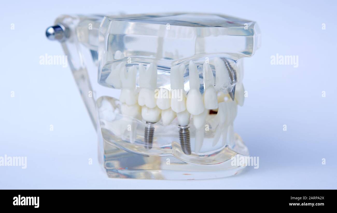 Titanium dental crown model hi-res stock photography and images - Alamy