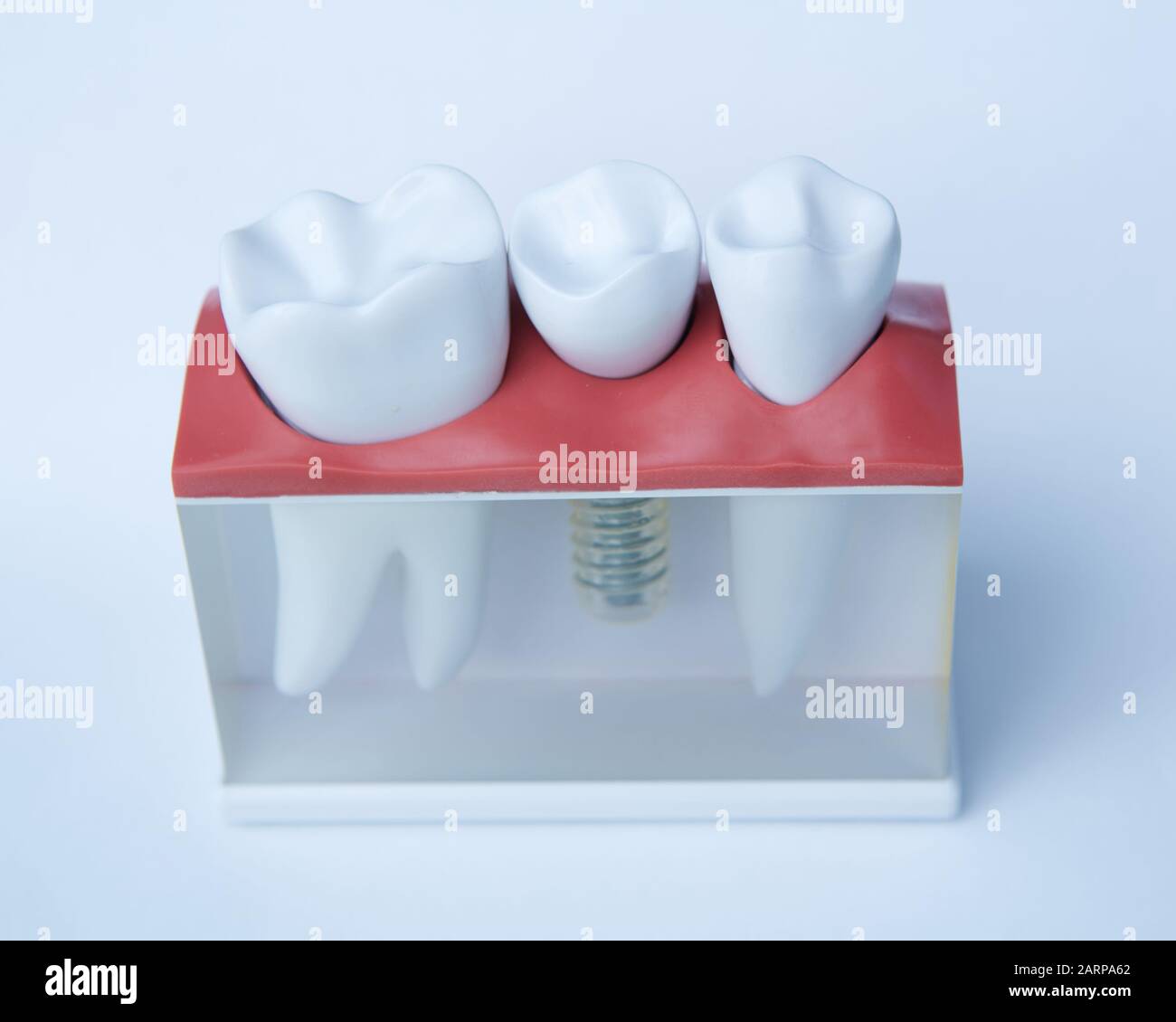 Dentists tooth plastic model with screw implant for teaching, learning ...