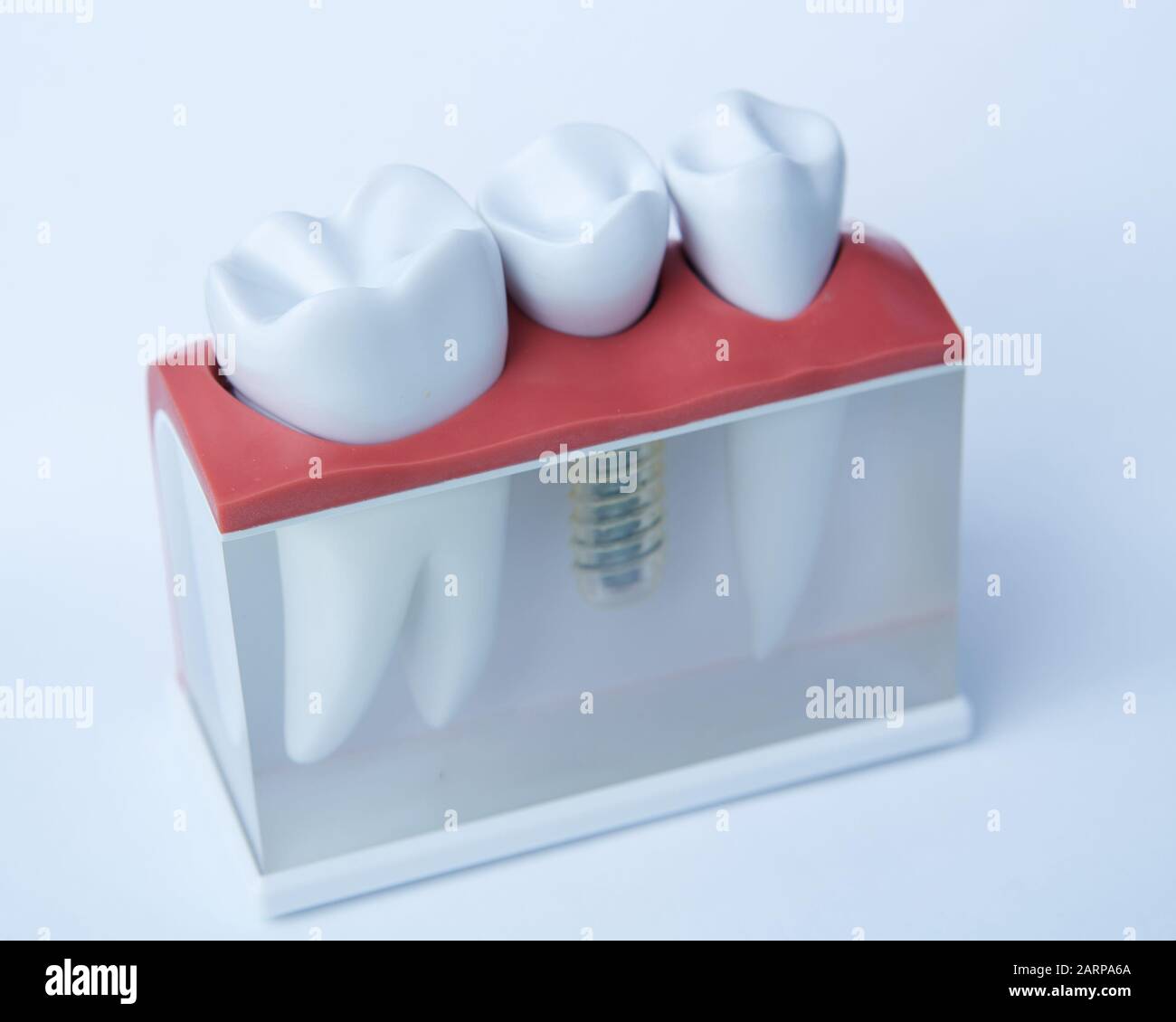 Dentists tooth plastic model with screw implant for teaching, learning ...