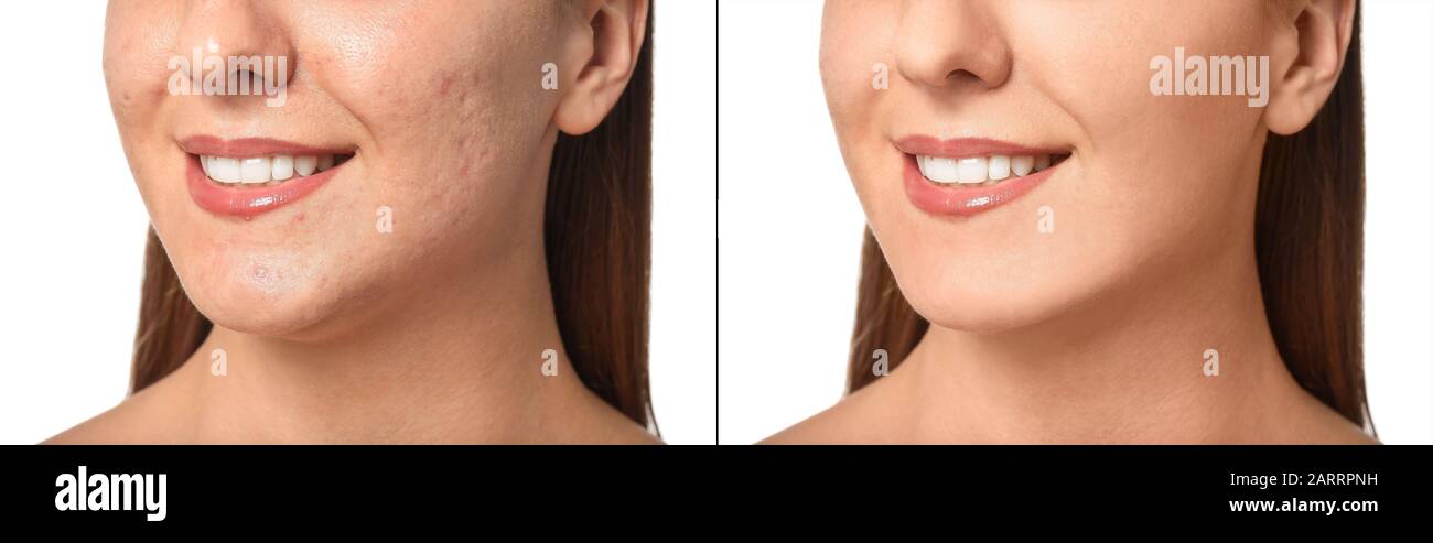 Young woman with and without acne on white background Stock Photo - Alamy