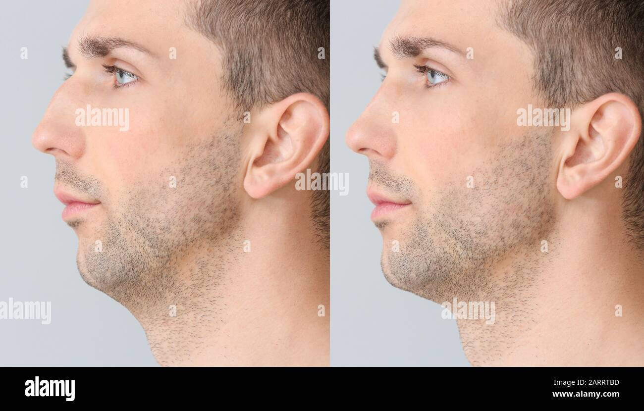 Young man before and after plastic operation on light background Stock ...