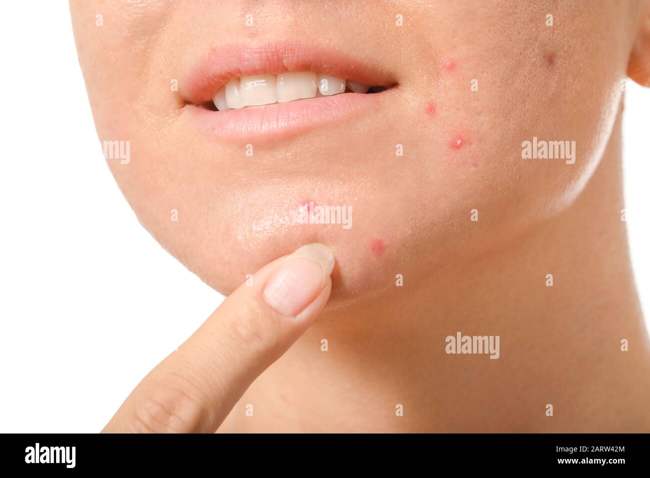 Young woman with acne problem on white background, closeup Stock Photo ...