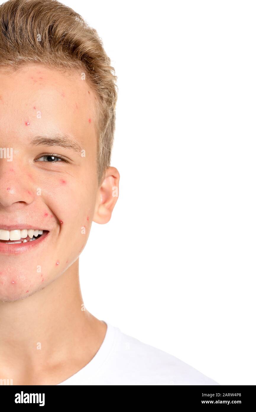 Teenage boy with acne problem on white background Stock Photo - Alamy