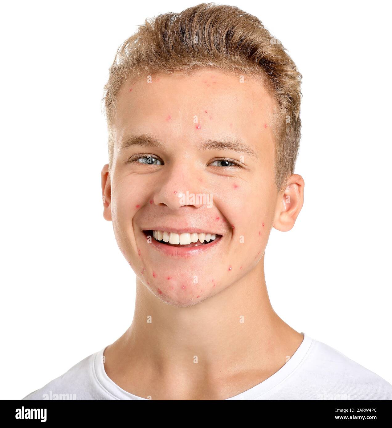 Teenage boy with acne problem on white background Stock Photo - Alamy