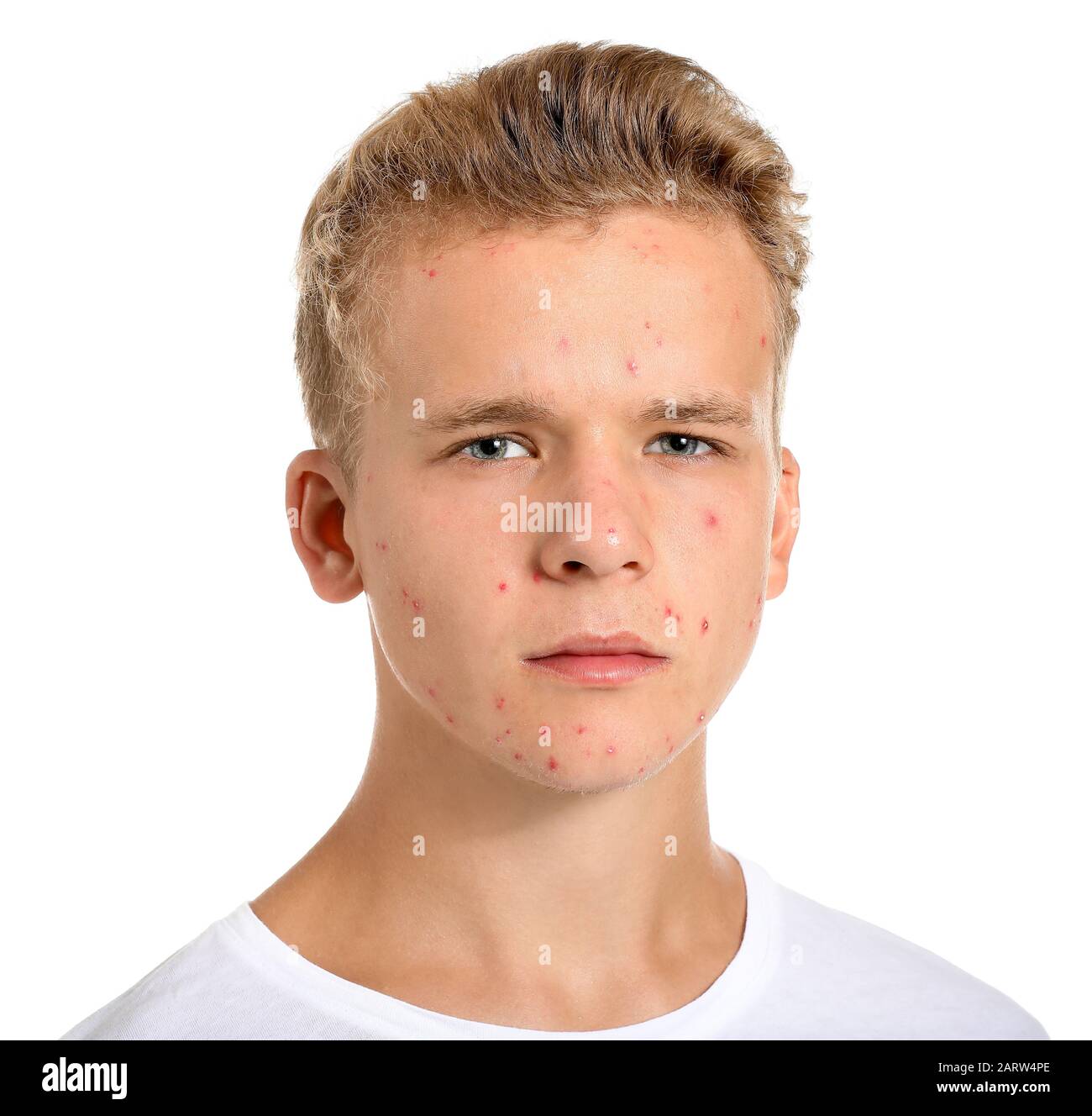 Teenage boy with acne problem on white background Stock Photo - Alamy