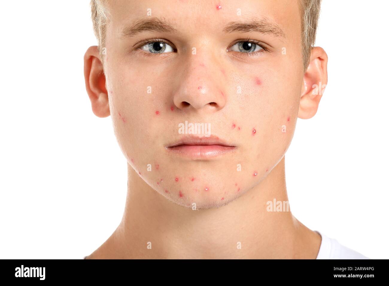Teenage boy with acne problem on white background Stock Photo - Alamy