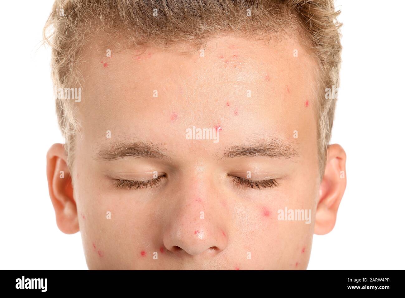 Teenage boy with acne problem on white background, closeup Stock Photo ...