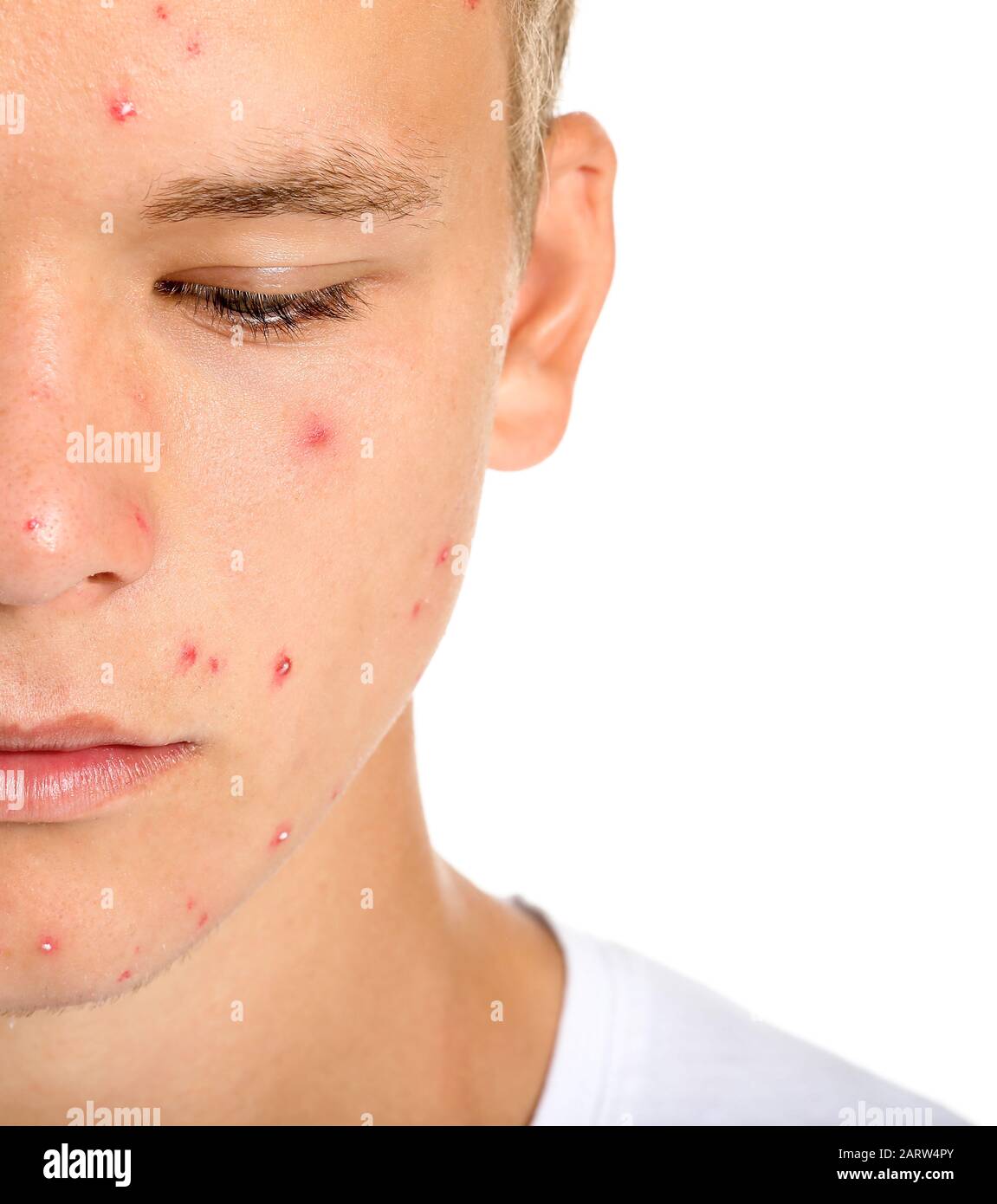 Teenage boy with acne problem on white background Stock Photo - Alamy