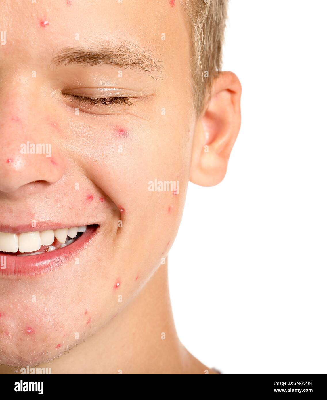 Teenage boy with acne problem on white background Stock Photo - Alamy