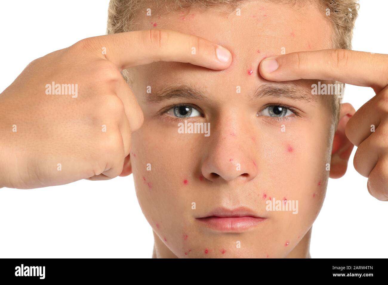Teenage boy with acne problem squishing pimples on white background ...